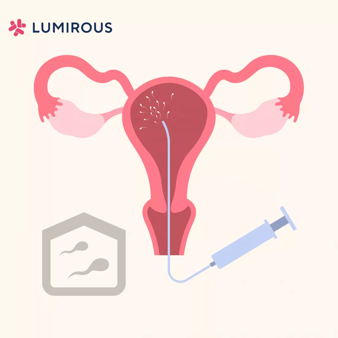A Comprehensive Guide To Intrauterine Insemination Iui Your One